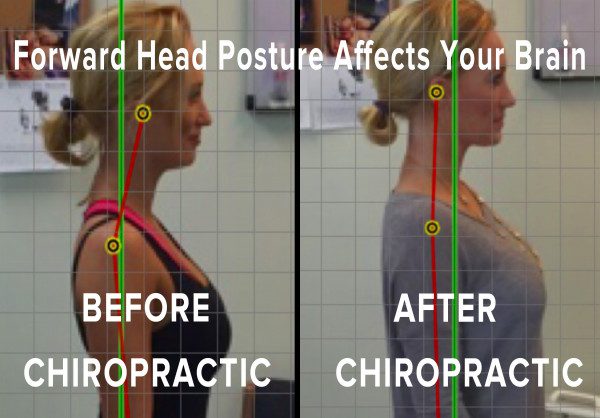 Forward Head Posture Effects Your Brain – Brain Based Health Solutions
